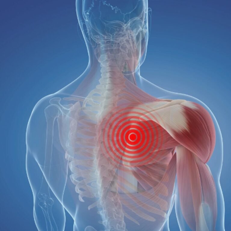 Scapular Dyskinesia & Stabilization Physiotherapy | My Pain Clinic Global