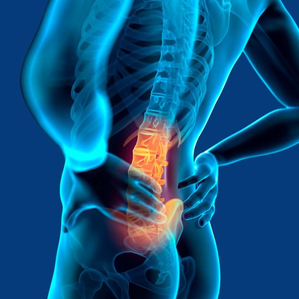 SI Joint Dysfunction - My Pain Clinic Global